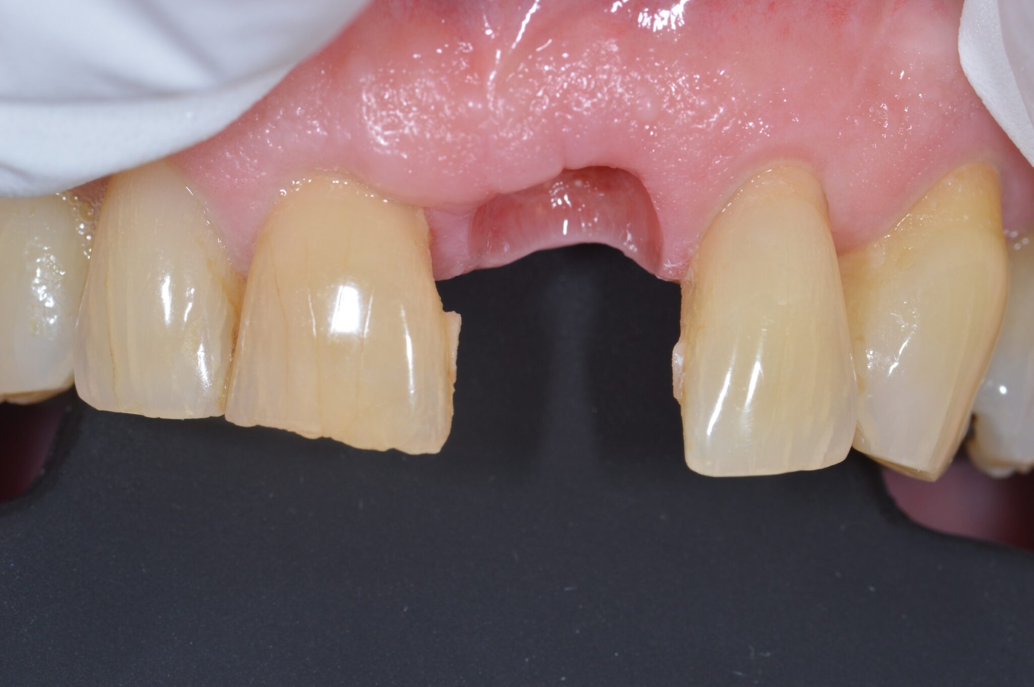 Making it look natural...| Dental Implants | Infinity Dental Clinic Blog