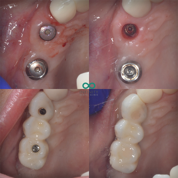 Replacing 3 teeth with 2 dental implants - the step by step approach