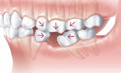 Over-eruption and drifting following tooth loss - Dental Implants
