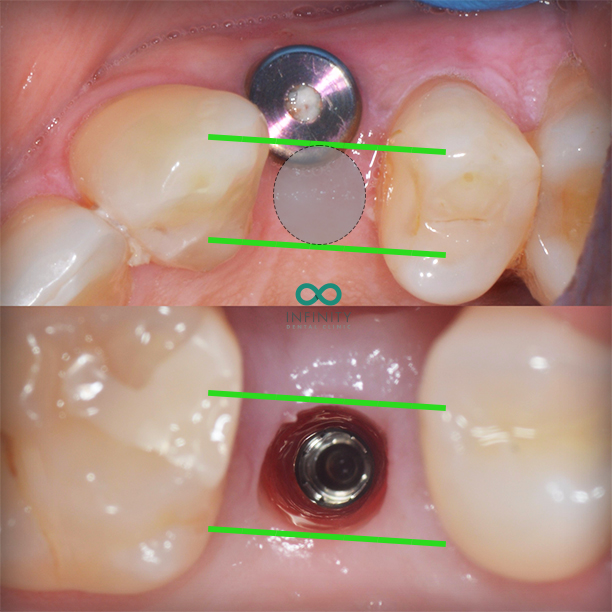 Implant positioning - The most important factor for long term success