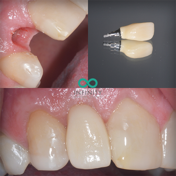 Gum shaping for a patient I love to treat! Infinity Dental Clinic