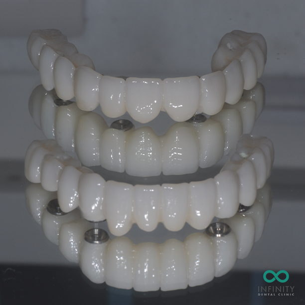 FULL ARCH IMPLANT DENTISTRY – THE MOST LIFE CHANGING OF ALL TREATMENTS ...