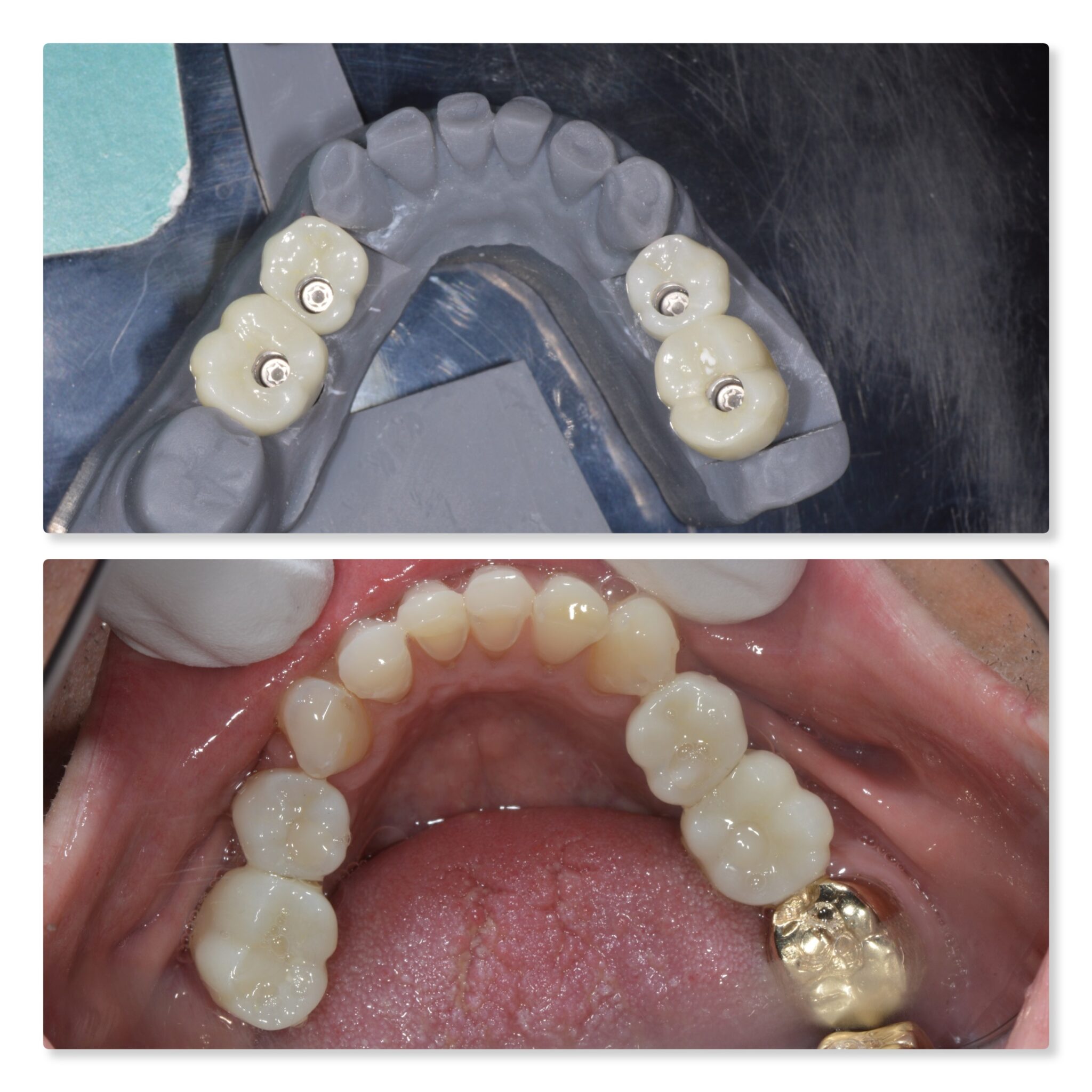 The molars hold the key to a perfect smile - Infinity Dental Clinic Leeds