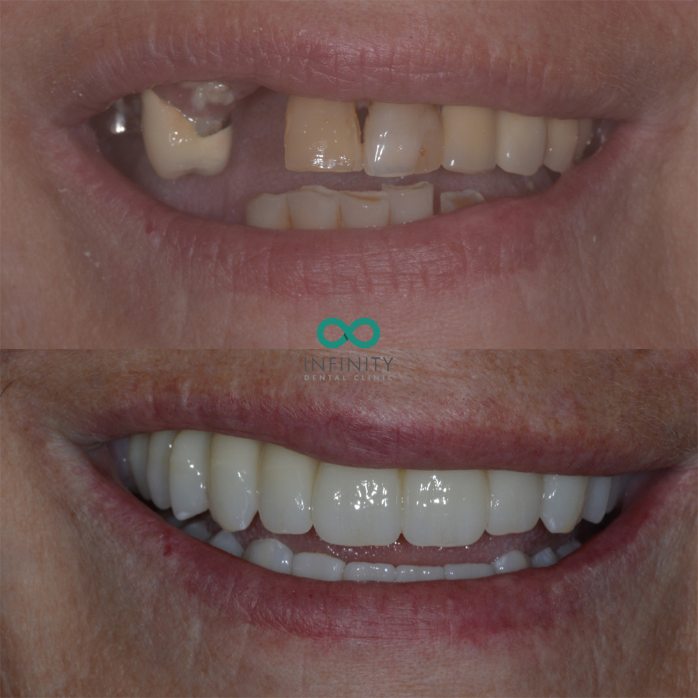 Getting our patient 'Wedding Ready' | Infinity Dental Clinic Leeds ...