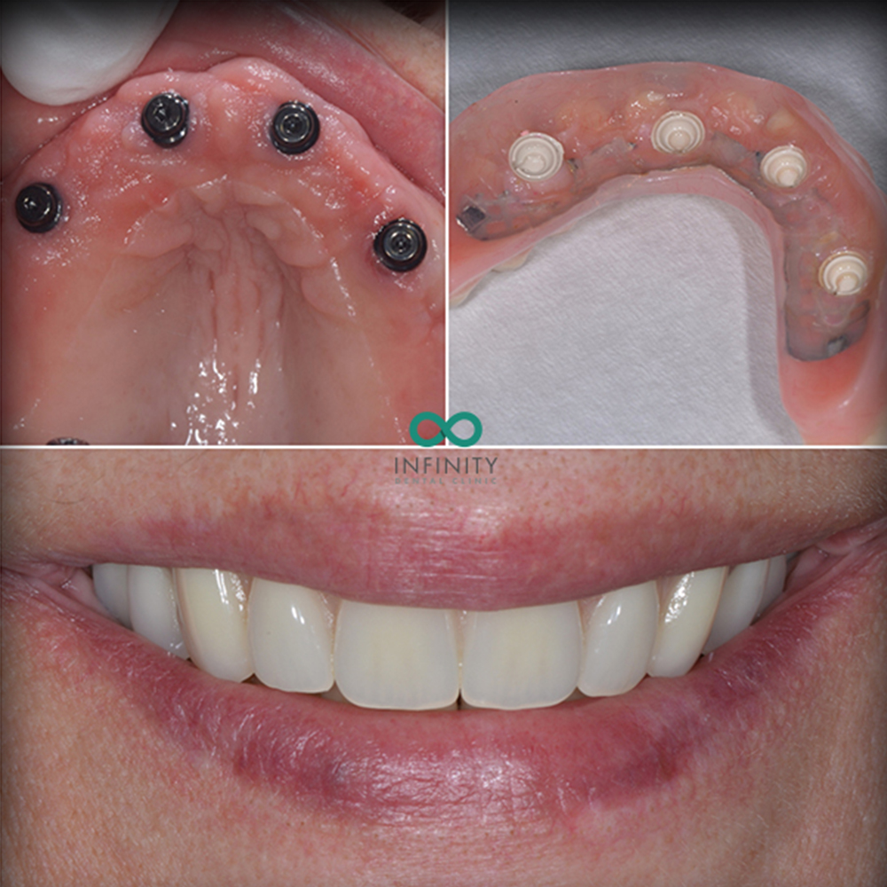 Dental Implant Retained Dentures | Infinity Dental Clinic Leeds