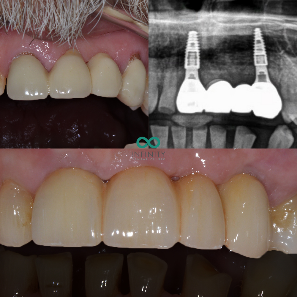 An implant bridge to restore this smile - 2 implants with 4 teeth