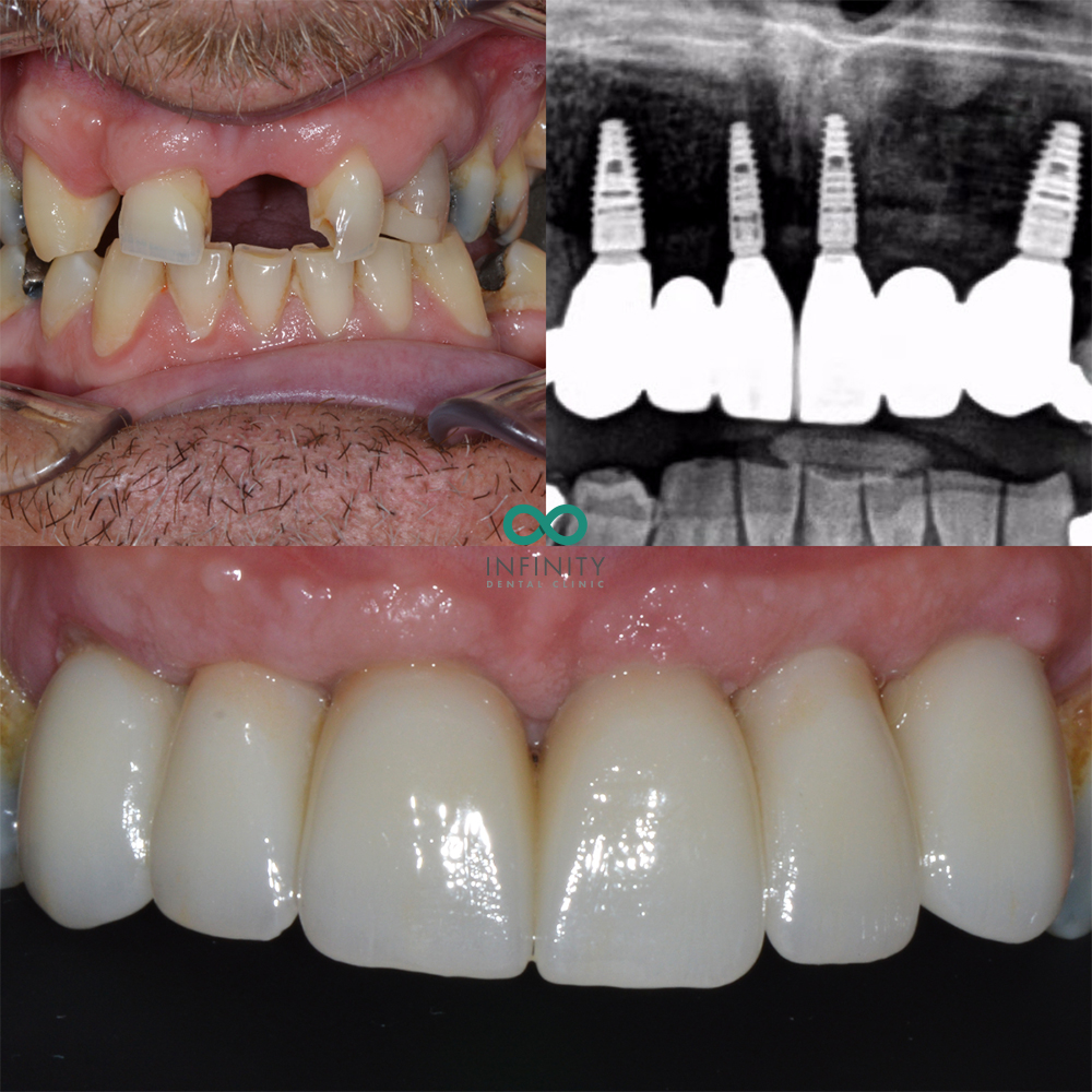 Restoring a smile with Dental Implants - from start to smile...