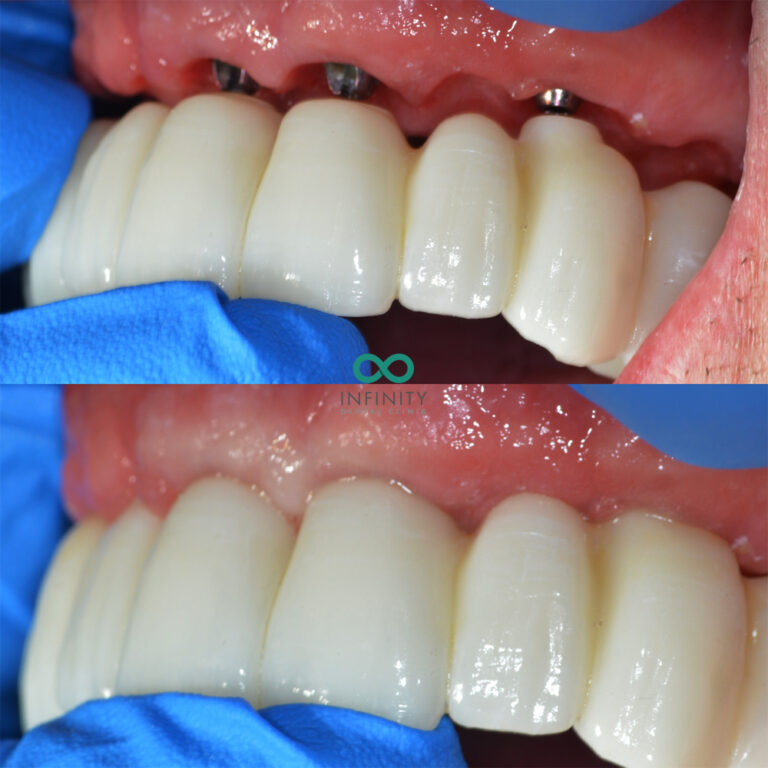 Restoring natural gum shapes around dental implants