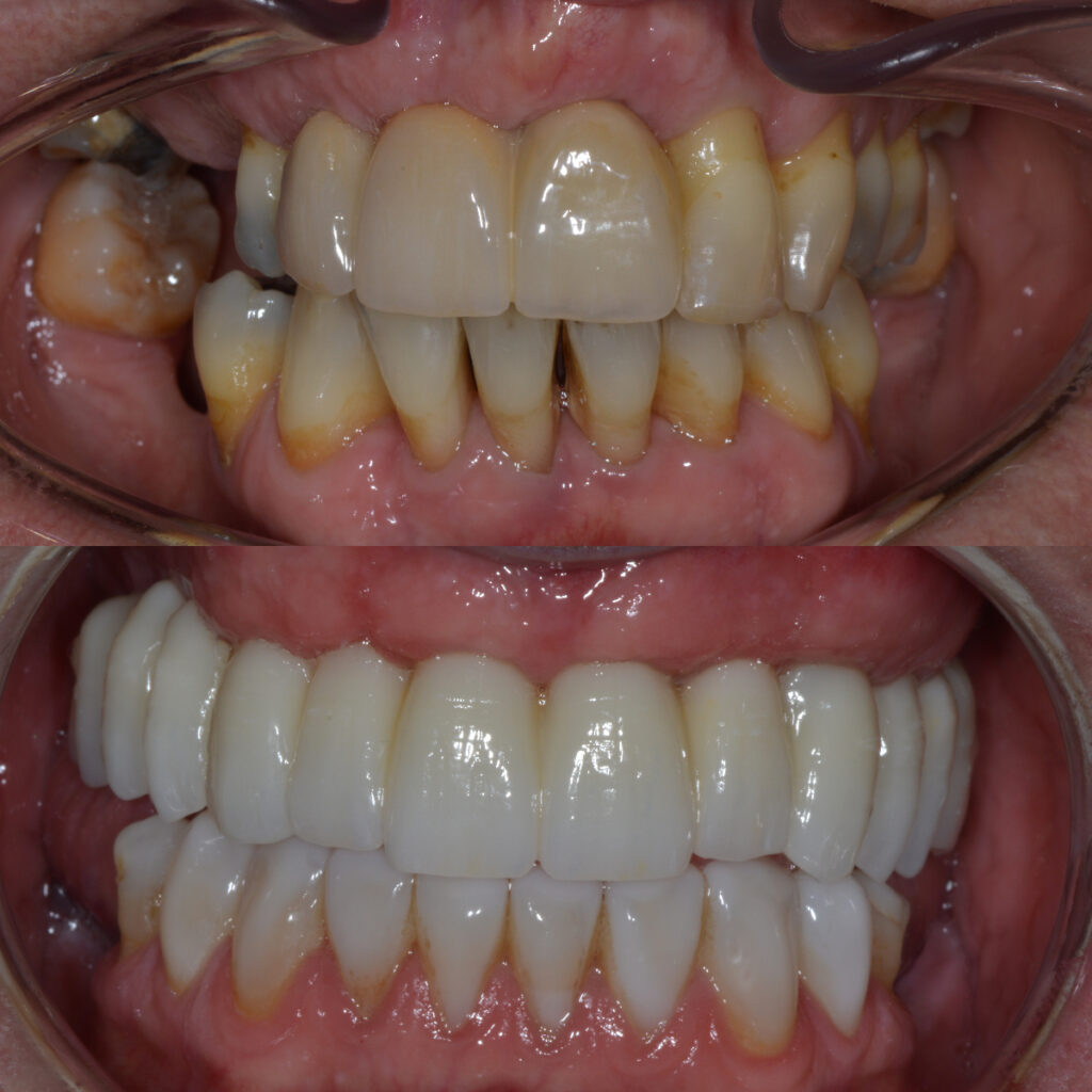 Restoring natural gum shapes around dental implants