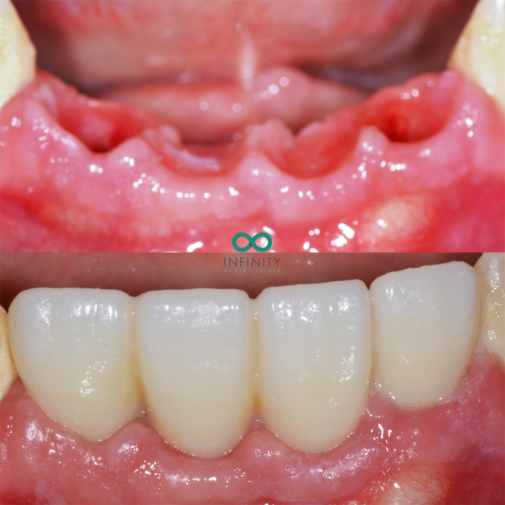 Restoring natural gum shapes around dental implants