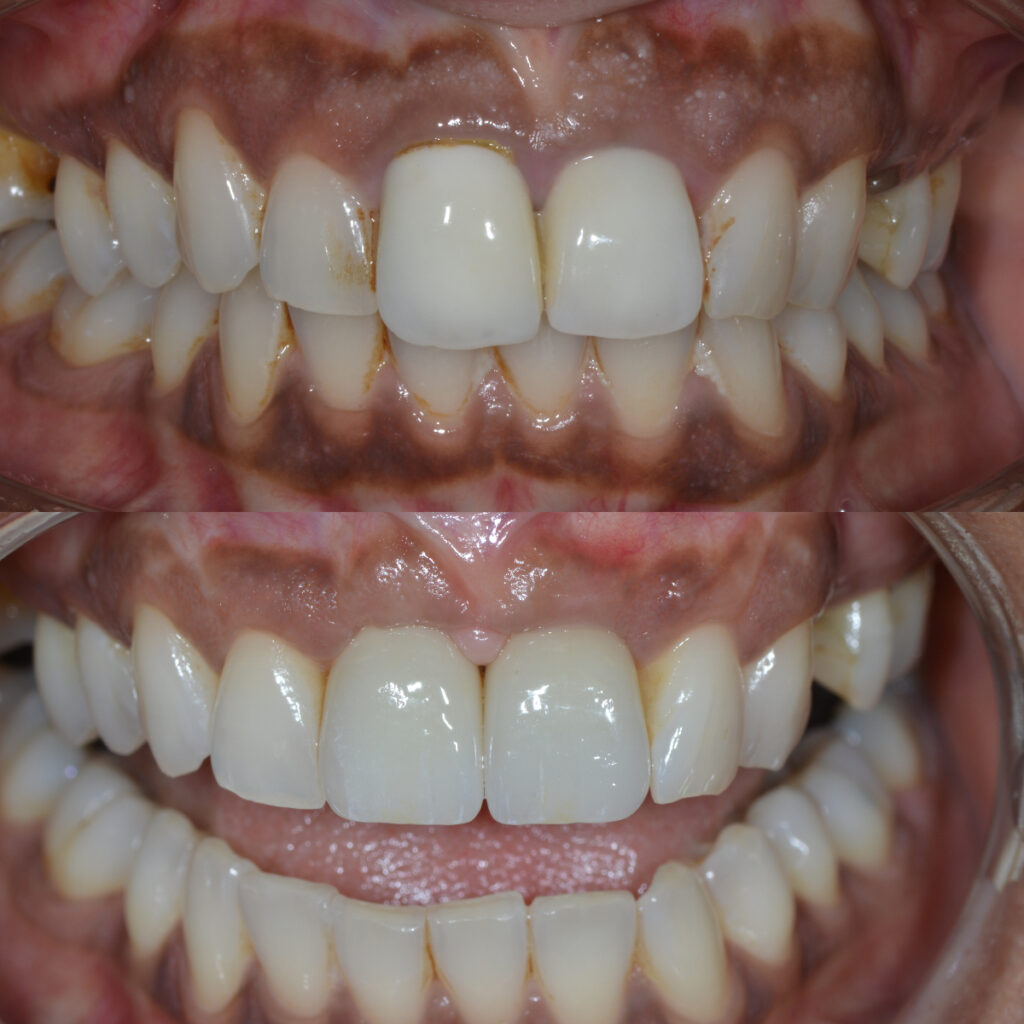 It's all about keeping it real | Dental Implants | Infinity Dental Clinic