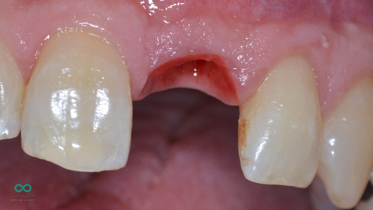 Creating single tooth replacements in the most natural way