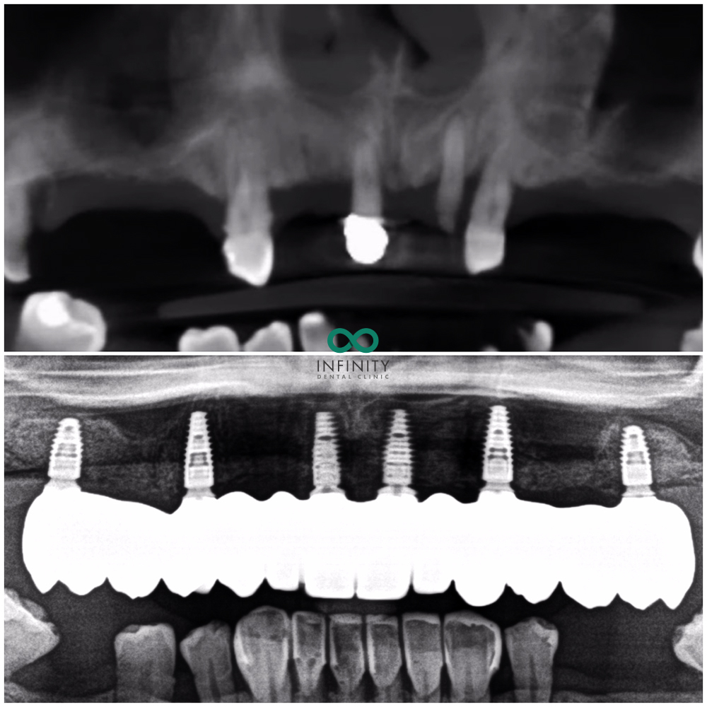 Sometimes the bone growth is extraordinary...