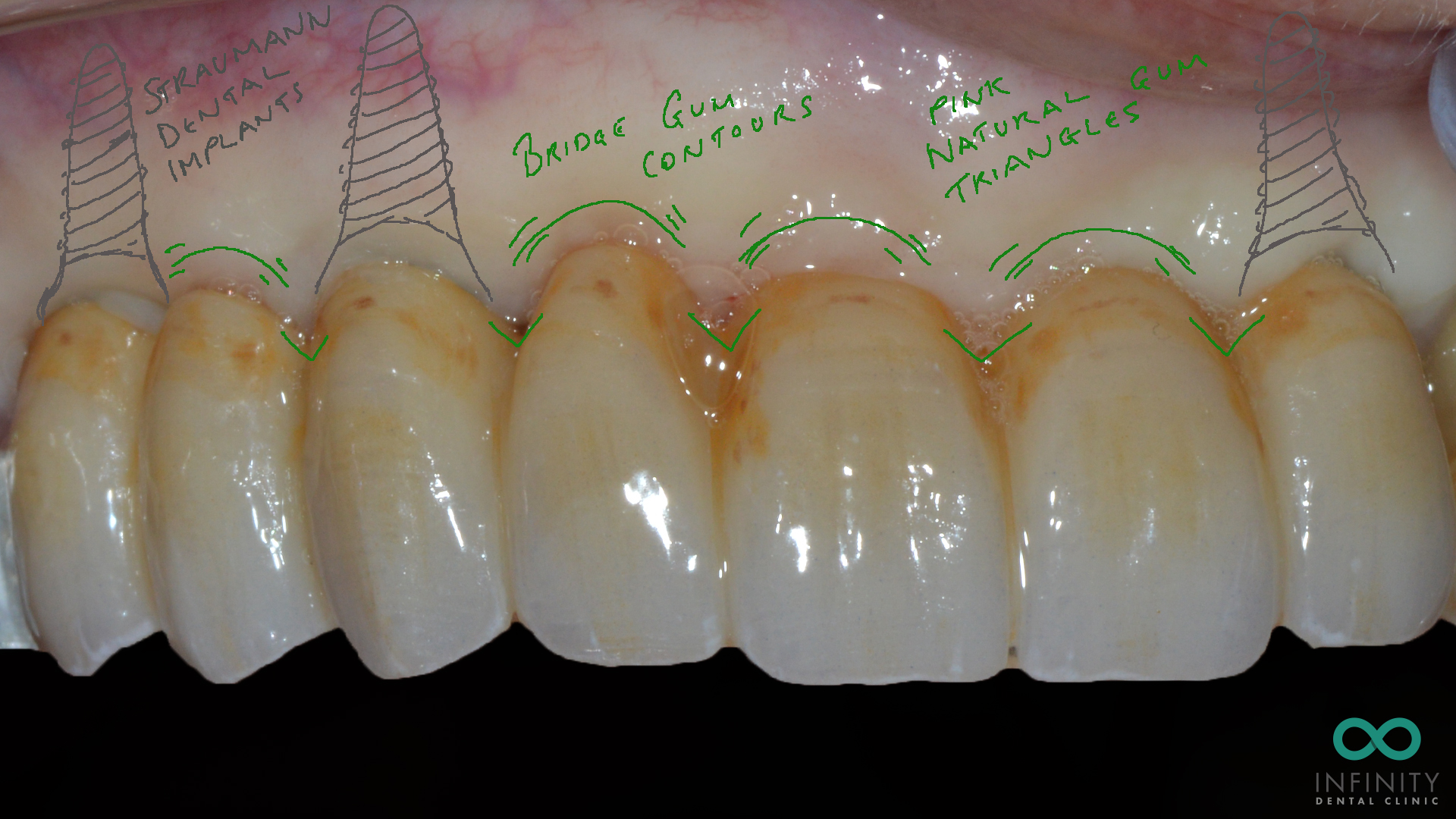 How we replace 7 teeth with 3 dental implants...