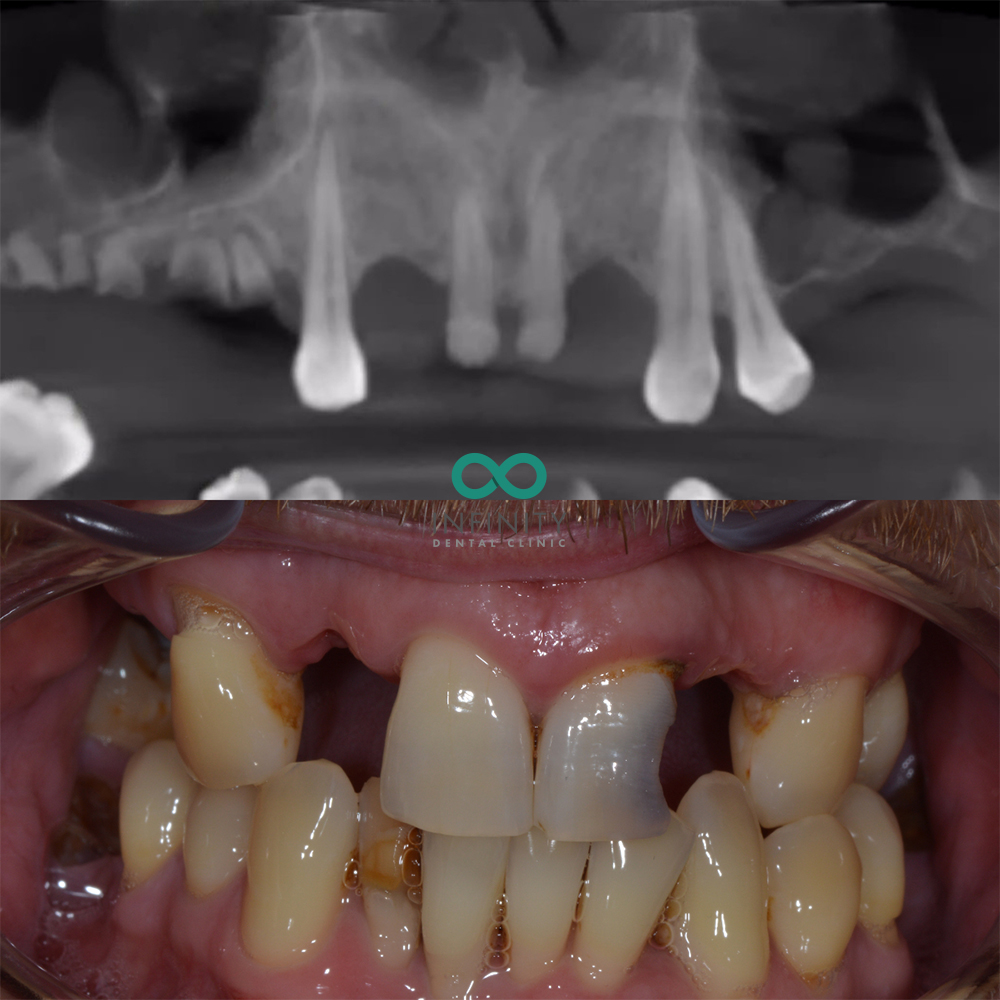 From no bone to a full arch of dental implants | Case Blog