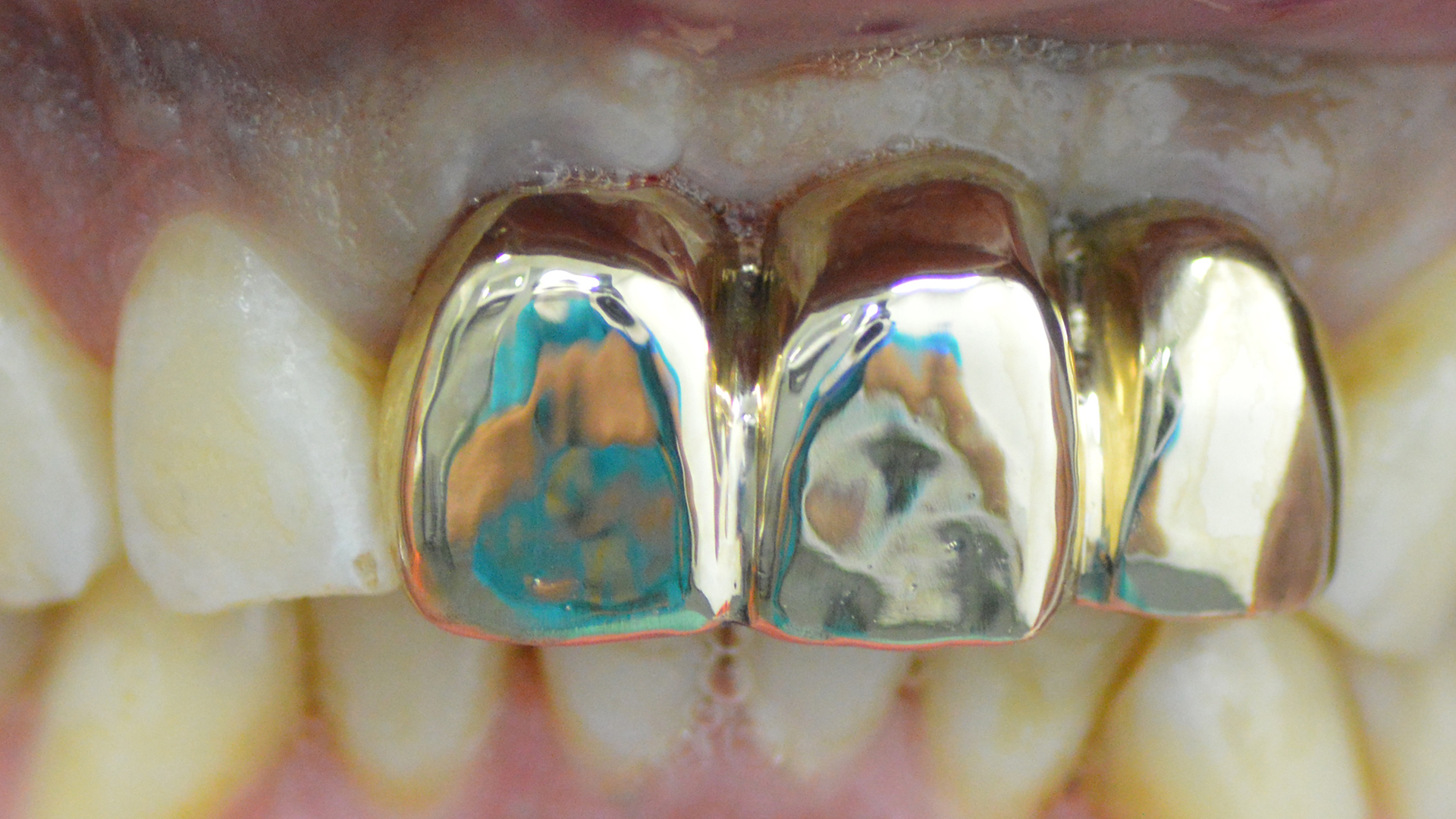 What is a bespoke smile? - Dental Implants and Gold Teeth...