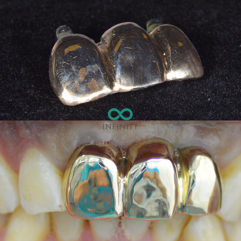 What is a bespoke smile? - Dental Implants and Gold Teeth...