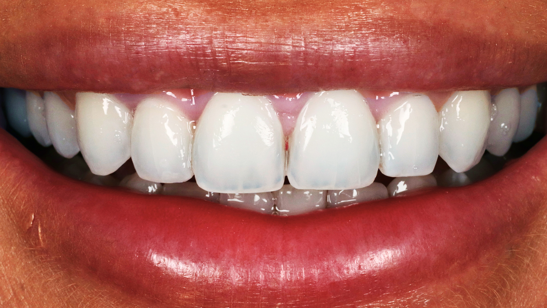 Composite Bonding VS Invisalign: Which is right for you?