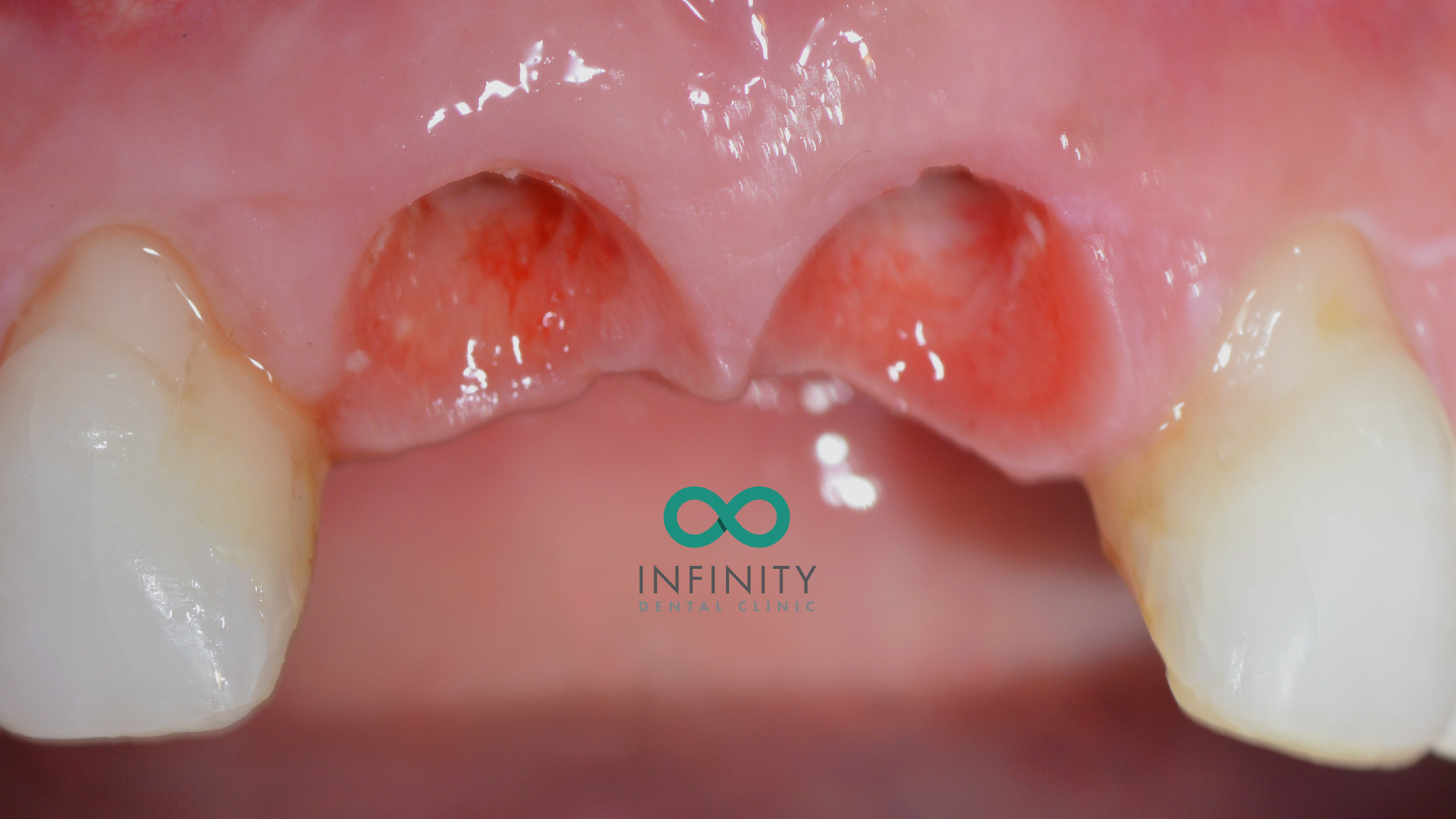 Restoring Confidence - A Journey with Dental Implants | Infinity Dental ...