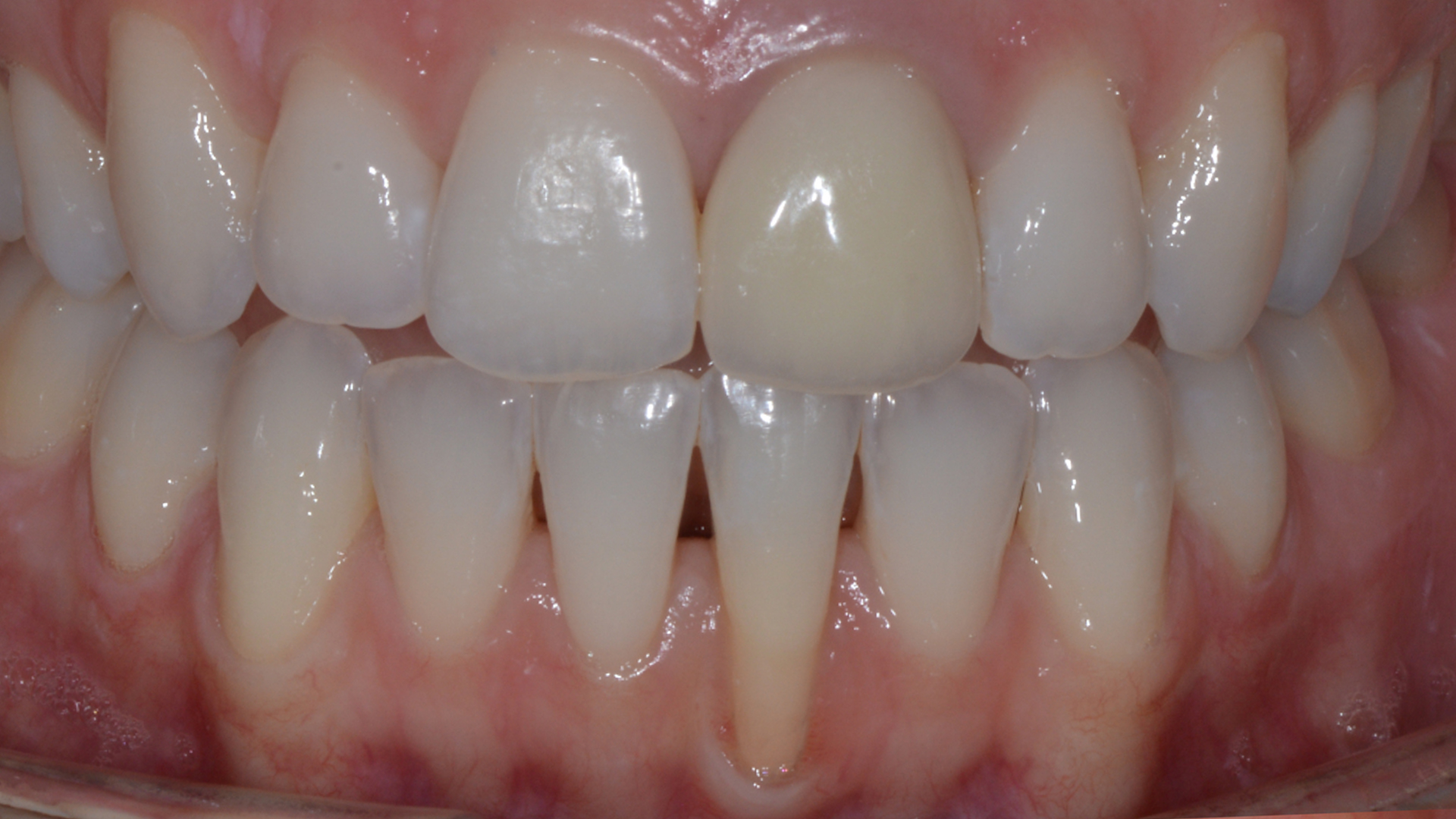 Gum Grafts and Dental Implants | Infinity Dental Clinic Leeds & Harrogate