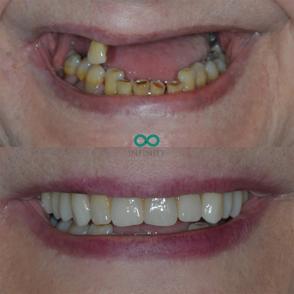 Transforming Smiles at Any Age: With Dental Implants