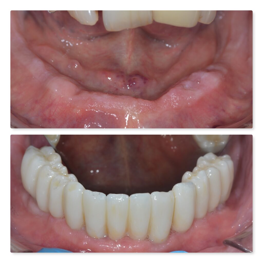 Transform Your Life with Same-Day-Teeth: Full Arch Dental Implants
