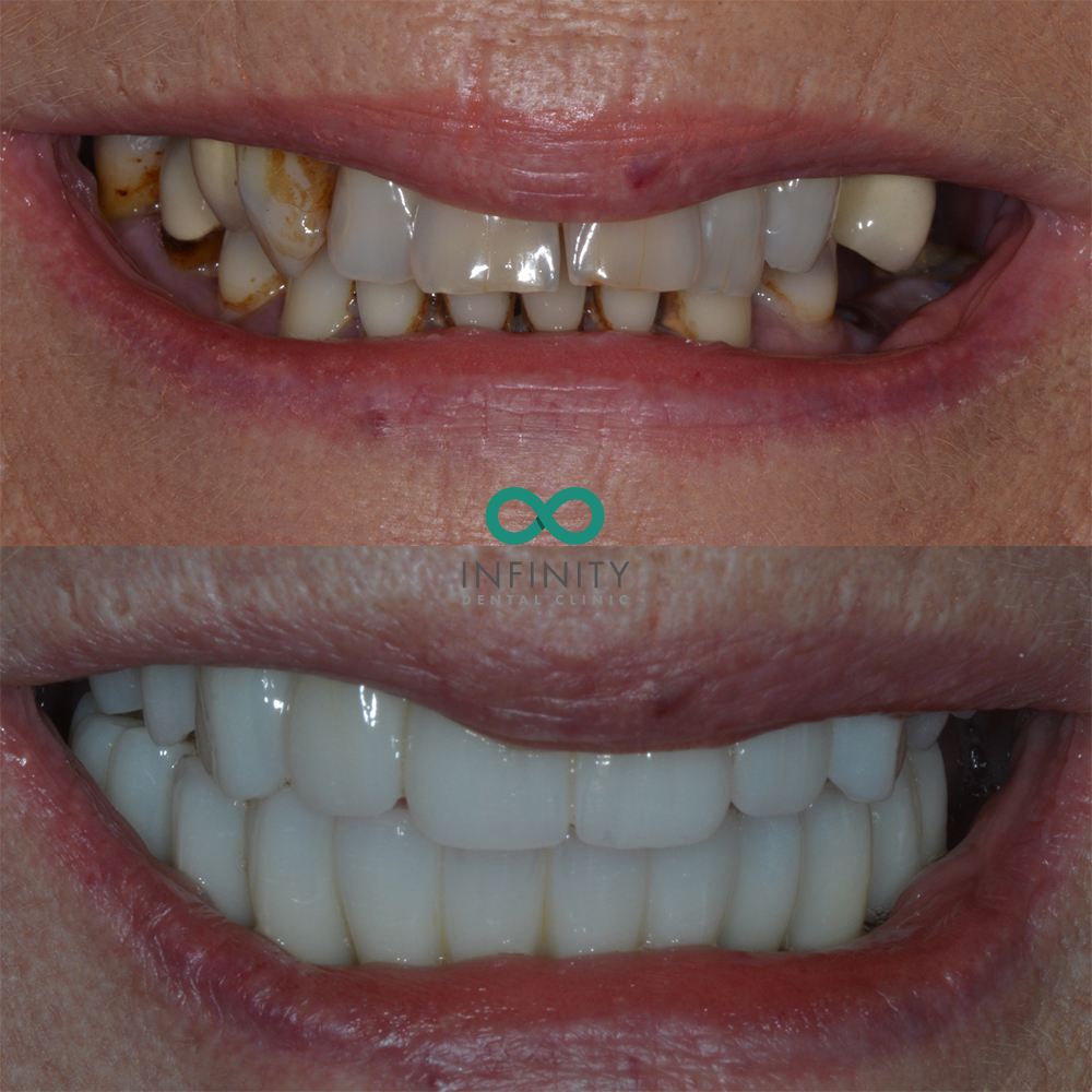 How Dental Implants Made a Wedding Unforgettable | Infinity Dental Clinic