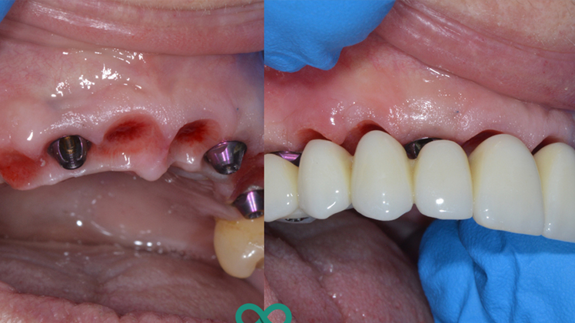 Transform Your Life with Same-Day-Teeth: Full Arch Dental Implants