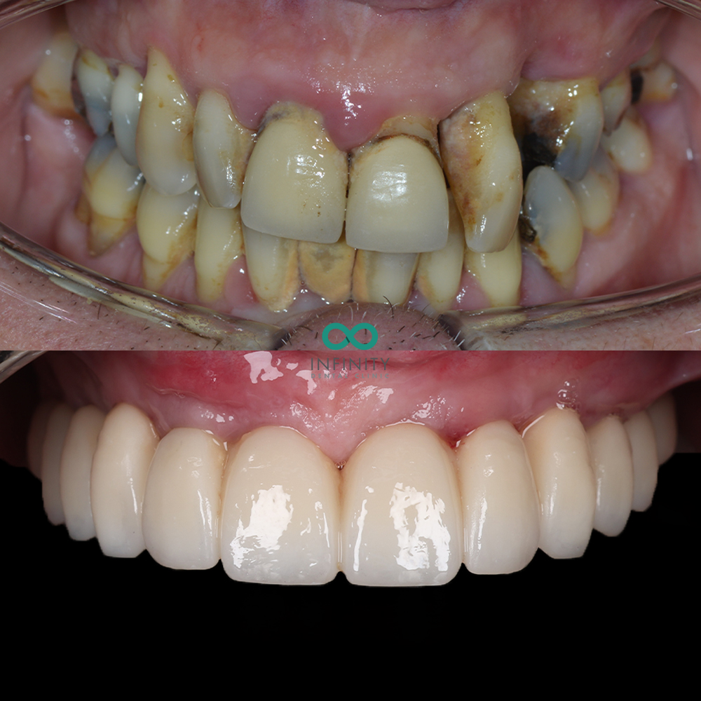 Rob's Smile Transformation: Replacing Failing Teeth with Same-Day ...