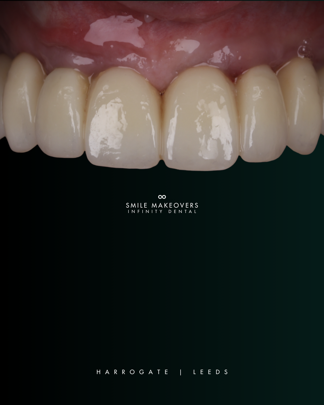 Recreating Nature: My Passion for FP1 Full Arch Implants | Infinity ...