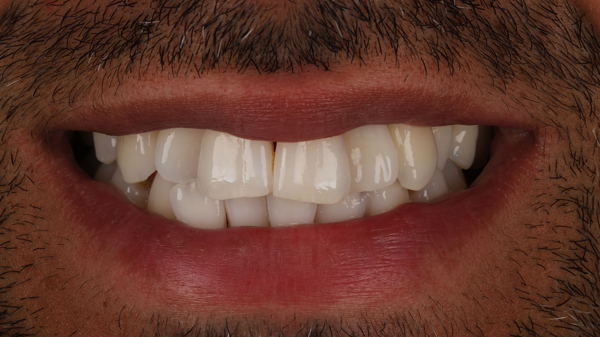 Guess Which One’s the Implant… | Infinity Dental Clinic Leeds & Harrogate