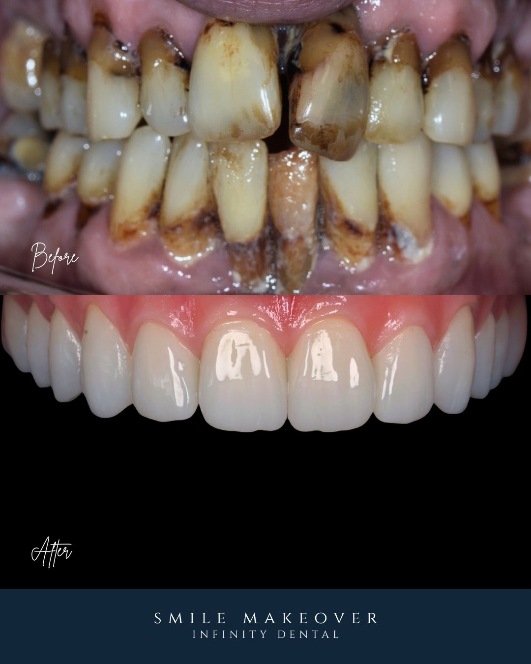 A Smile He No Longer Had to Hide | Infinity Dental Clinic Leeds & Harrogate